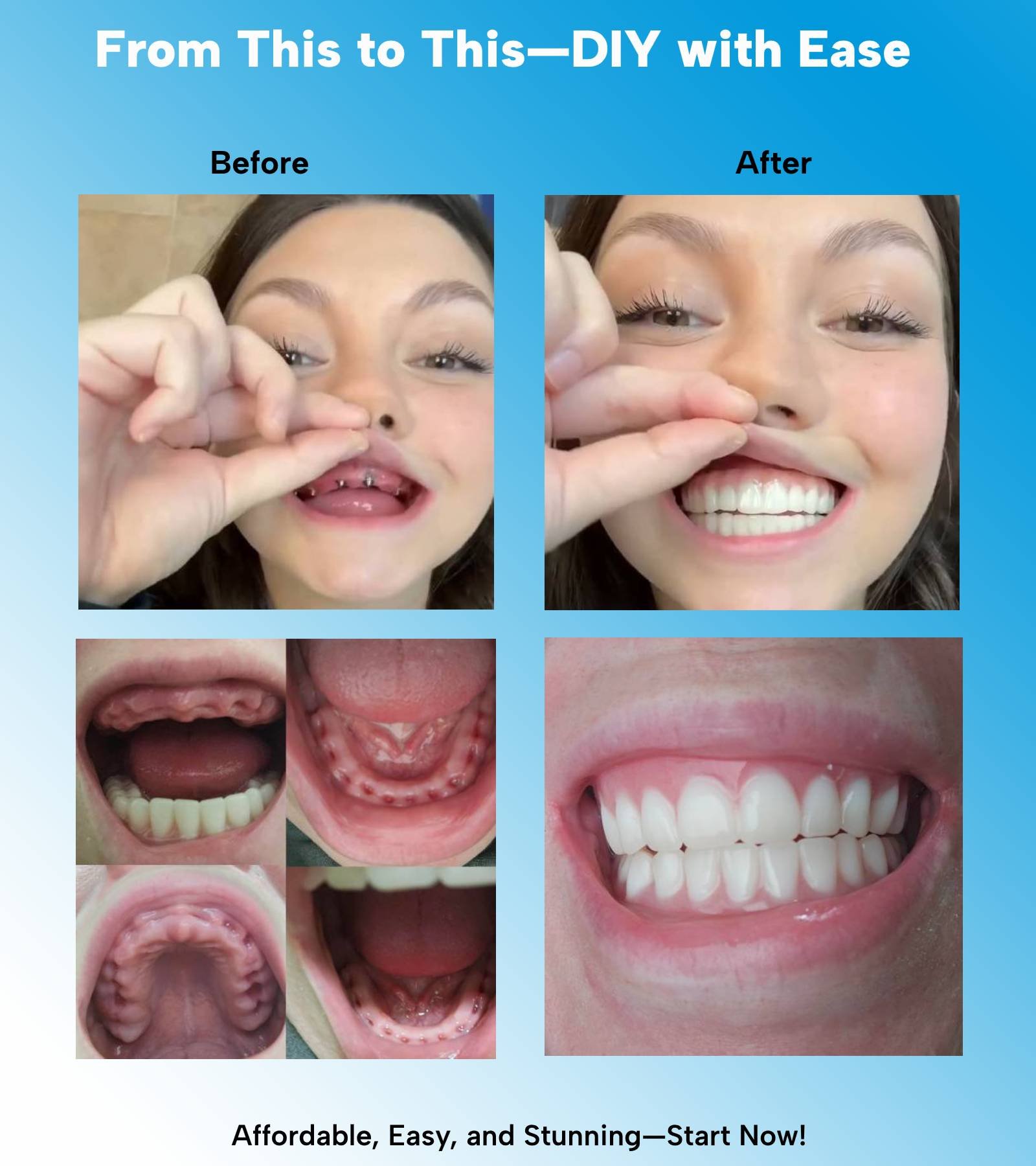 DIY Denture Kit Repair Missing Teeth Fake Teeth - AiHealth-Denture Care